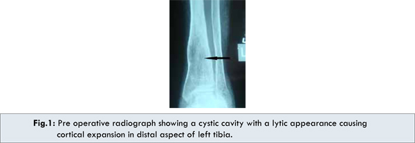 Intraosseous Lipoma of Distal Tibia Intraosseous Lipoma of Distal Tibia