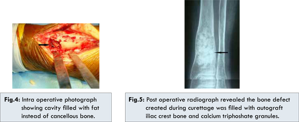 Intraosseous Lipoma of Distal Tibia Intraosseous Lipoma of Distal Tibia