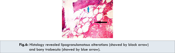 Intraosseous Lipoma of Distal Tibia Intraosseous Lipoma of Distal Tibia