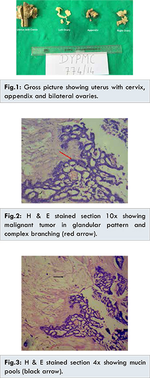 Pseudomyxoma Peritonei A Rare Case Report With Review Of Literature